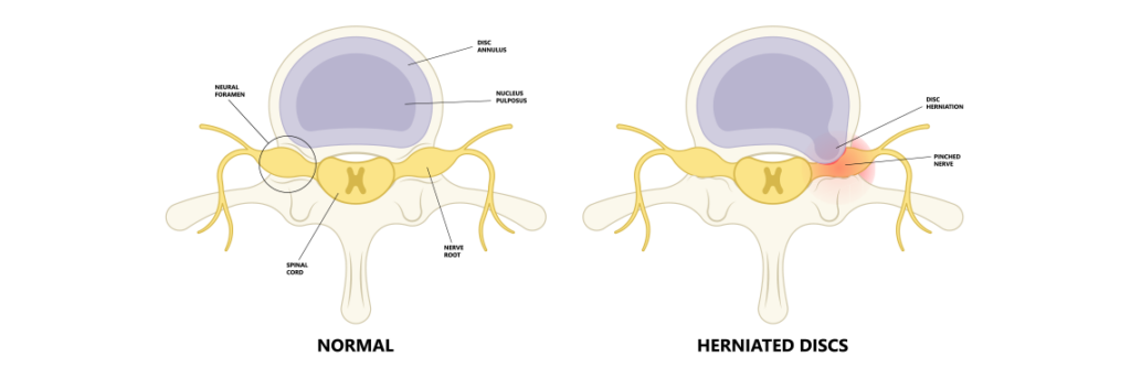 New Study Shows Surgery for Herniated Disk Improve Faster | Keystone ...